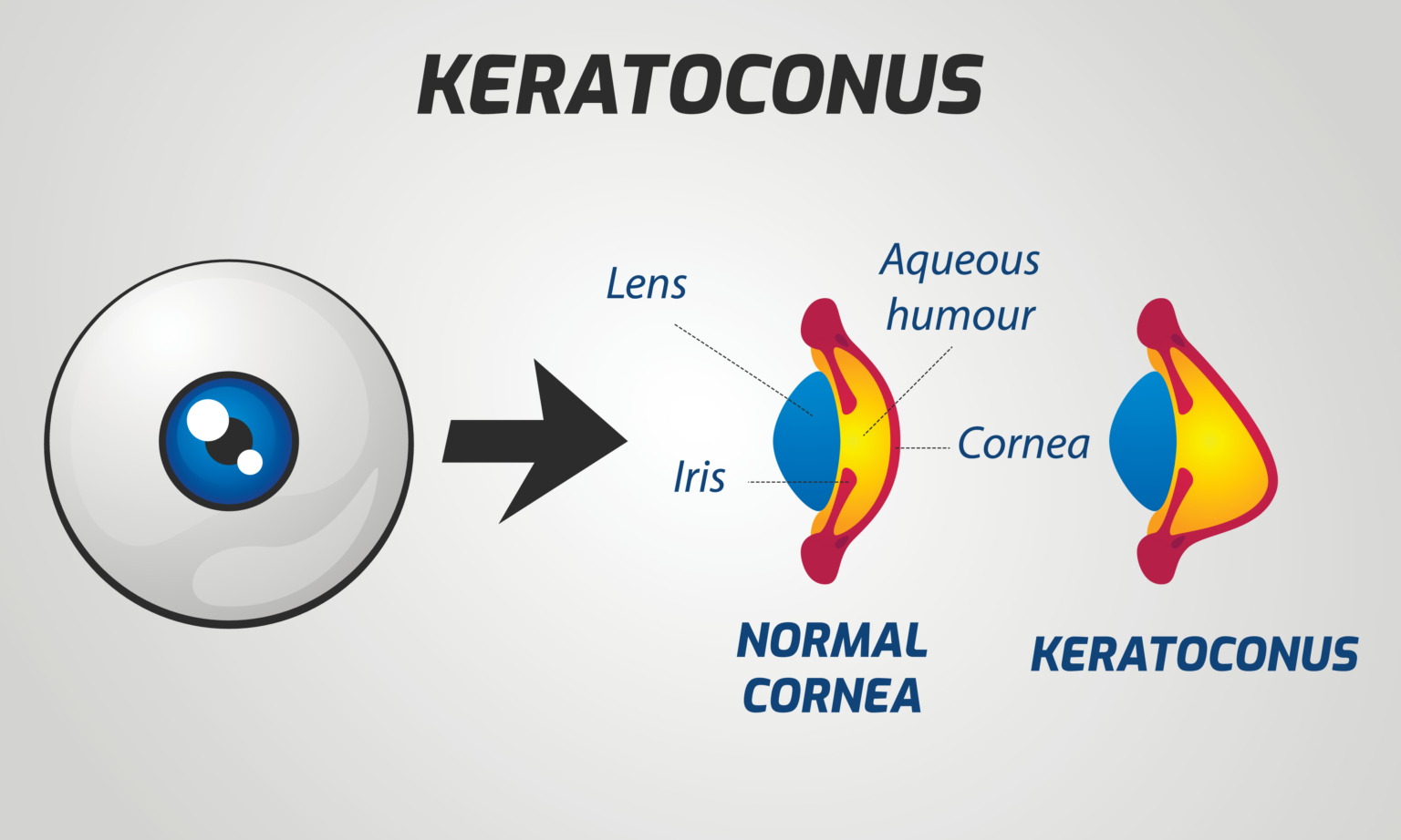 What Does The Cornea Do? | Eye Consultants of Fargo
